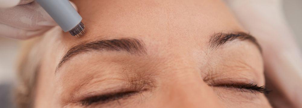 Vampire Facials - Benefits & Risks - Anne Arundel Dermatology